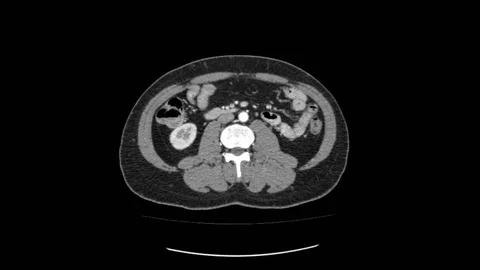 ct scan of upper abdomen top view smooth... | Stock Video | Pond5