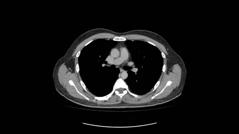 ct scan of upper abdomen top view smooth... | Stock Video | Pond5