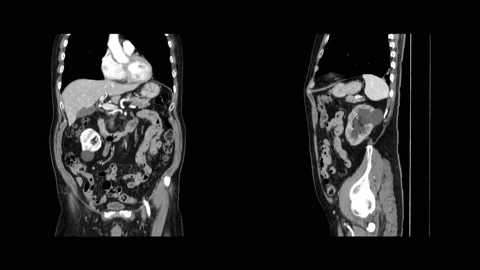 CT scan whole abdomen with contrast medi... | Stock Video | Pond5