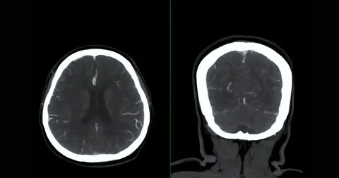 Stroke Tomography Stock Videos – Royalty-Free HD & 4K Videos