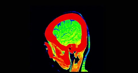 CTA Brain SCAN of the brain in colorful ... | Stock Video | Pond5