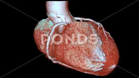 CTA coronary artery 3D rendering is a diagnostic imaging technique ...