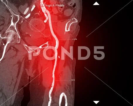 CTA femoral artery run off image of femoral artery for diagnosis Acute ...