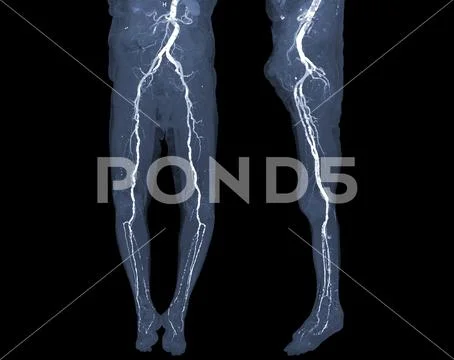 CTA femoral artery run off image of femoral artery for diagnosis Acute ...