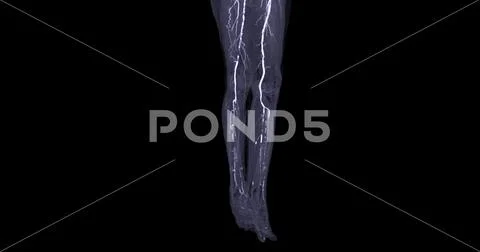 CTA femoral artery run off image of femoral artery for diagnostic Acute ...