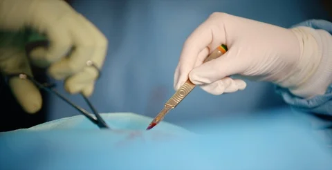 Incision Stock Video Footage | Royalty Free Incision Videos | Pond5