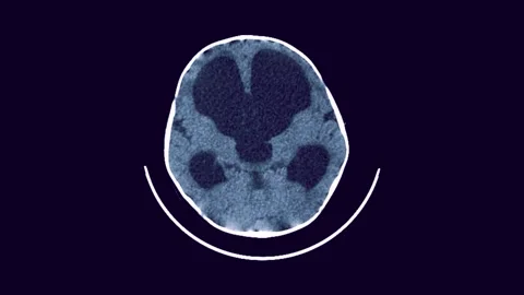 Dandy-Walker syndrome, CT scan | Stock Video | Pond5