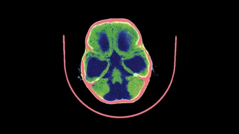 Dandy-Walker syndrome, CT scan | Stock Video | Pond5