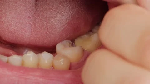 Deep caries in the patient's jaw tooth a... | Stock Video | Pond5