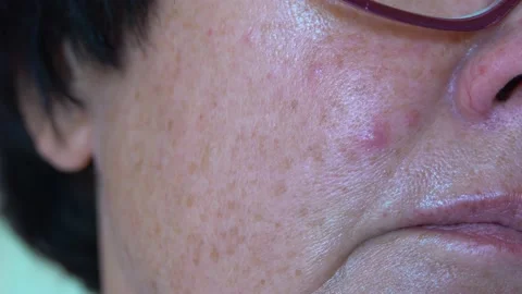 Defects of the skin of the face | Stock Video | Pond5