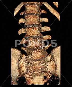 Degenerative disc disease, 3d ct scan Illustration #11177528