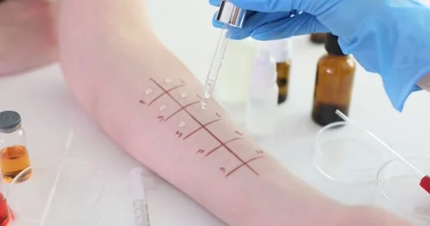 Demonstration of allergy skin test proce... | Stock Video | Pond5