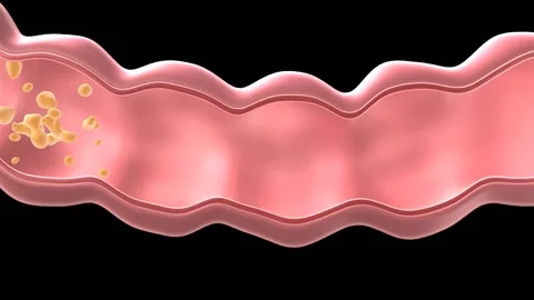 Demonstration of intestinal toxin accumu... | Stock Video | Pond5