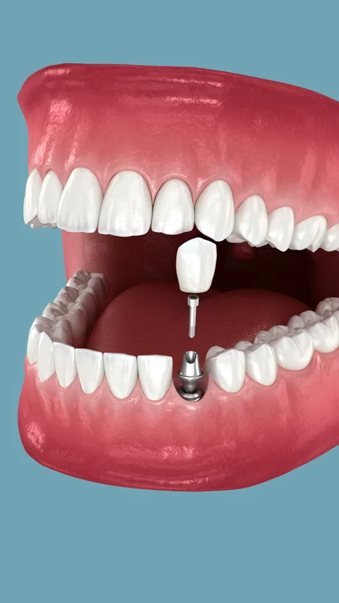 Dental Implant Animation 库存视频影片 | 免版税Dental Implant Animation 视频 | Pond5