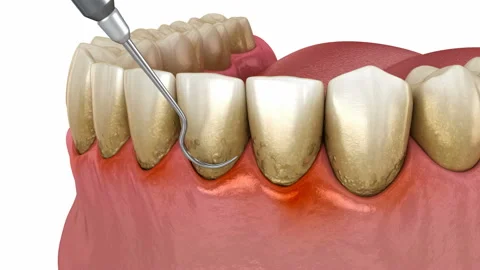 Dental scaling (conventional periodontal... | Stock Video | Pond5