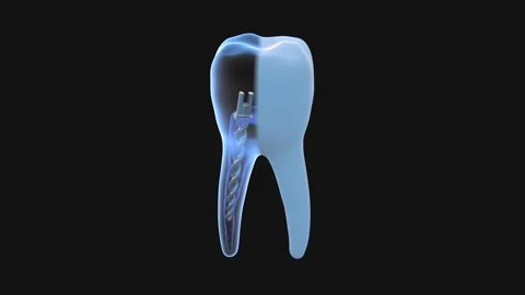 Dental steel post inside molar teeth, Xr... | Stock Video | Pond5