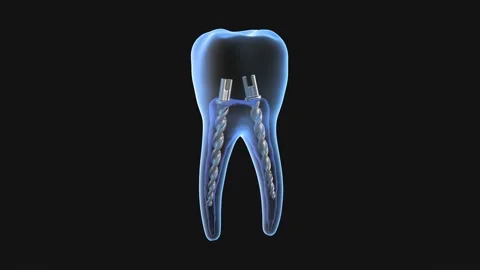 Dental steel post inside molar teeth, Xr... | Stock Video | Pond5