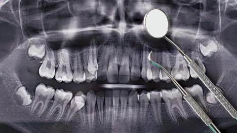 Dental X-ray scan of teeth, close-up. Pa... | Stock Video | Pond5