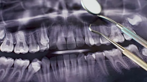 Dental X-ray scan of teeth, close-up. Pa... | Stock Video | Pond5
