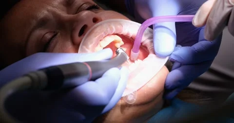 Dentist collects saliva with saliva ejec... | Stock Video | Pond5