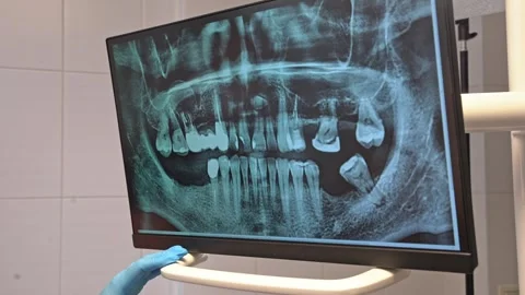 Dentist hand explore study teeth mouth c... | Stock Video | Pond5