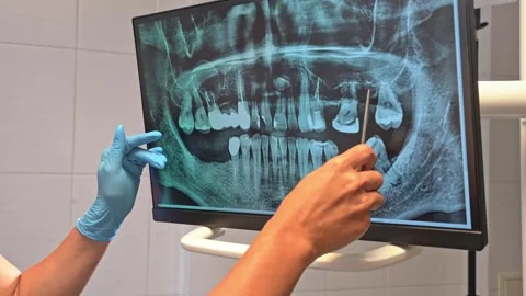 Dentist hand explore study teeth mouth c... | Stock Video | Pond5