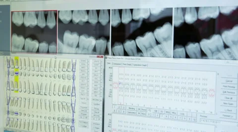 Dentist Xrays of Teeth on Monitor | Stock Video | Pond5