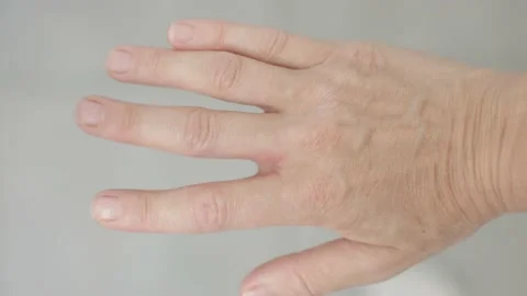 dermatitis hands palm skin itchy scratch... | Stock Video | Pond5