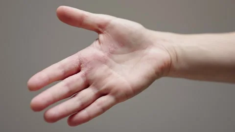 dermatitis hands palm skin itchy scratch... | Stock Video | Pond5