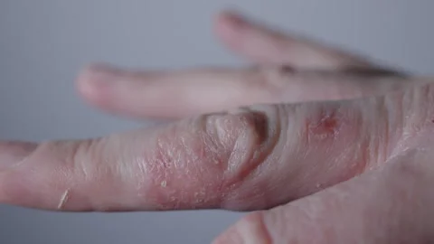 dermatology dry skin eczema disease psor... | Stock Video | Pond5