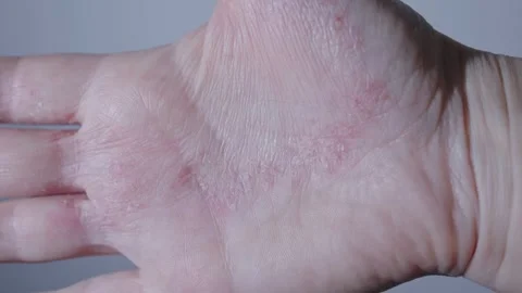 dermatology dry skin eczema disease psor... | Stock Video | Pond5