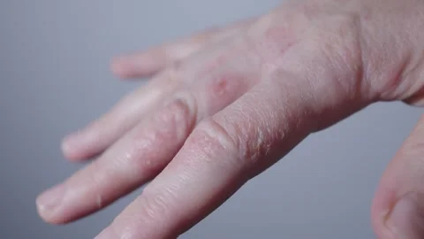 dermatology dry skin eczema disease psor... | Stock Video | Pond5
