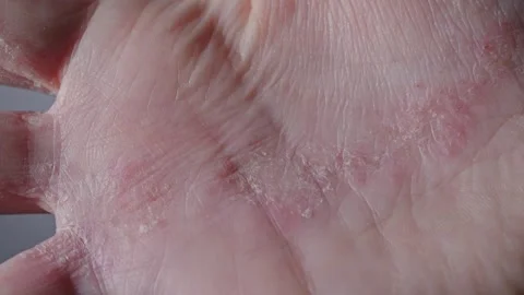 dermatology dry skin eczema disease psor... | Stock Video | Pond5
