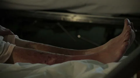 Dermatology. Open wounds on legs. Skin d... | Stock Video | Pond5