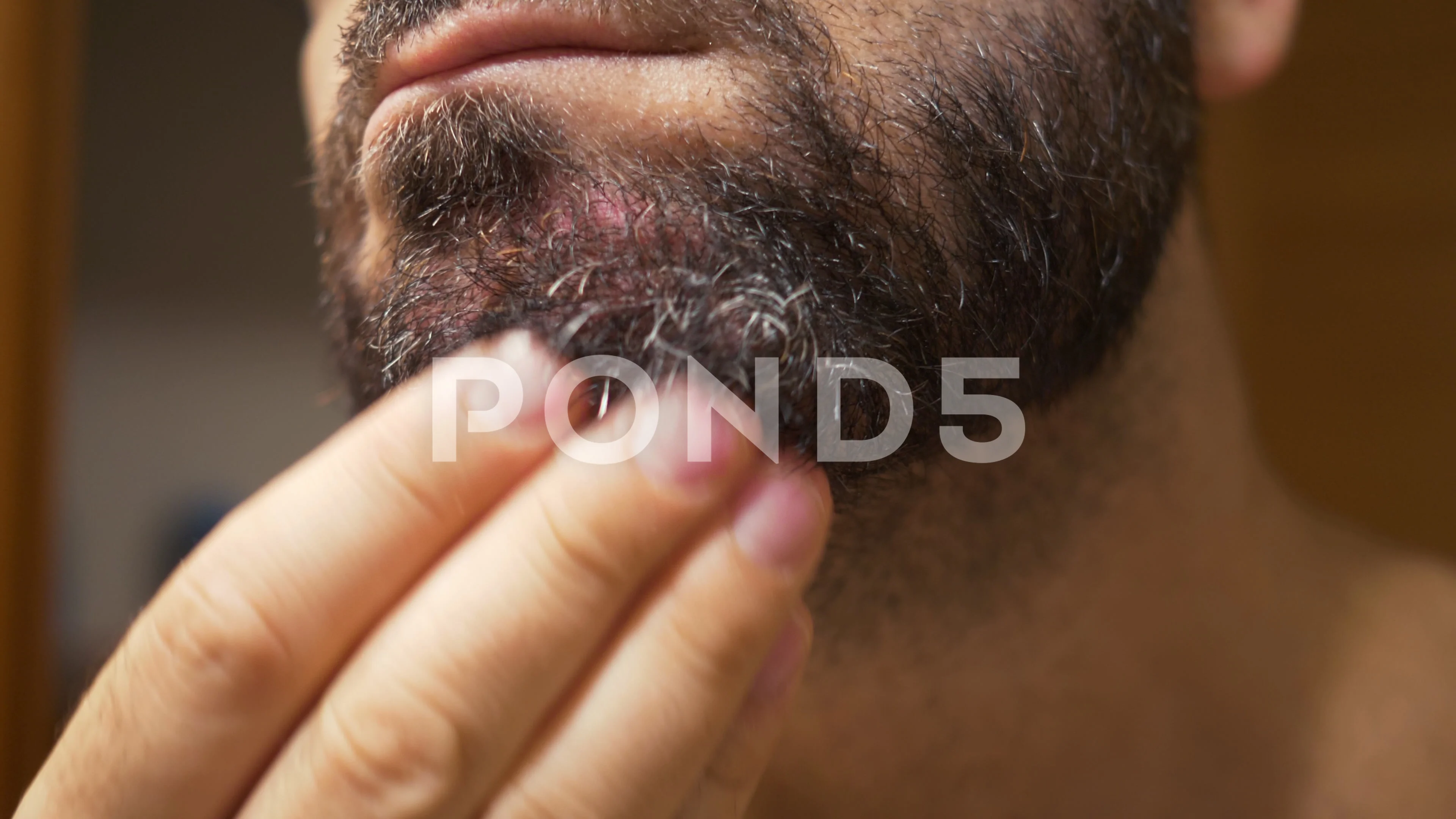 Types Of Eczema: Seborrheic Dermatitis Gladskin, 54% OFF