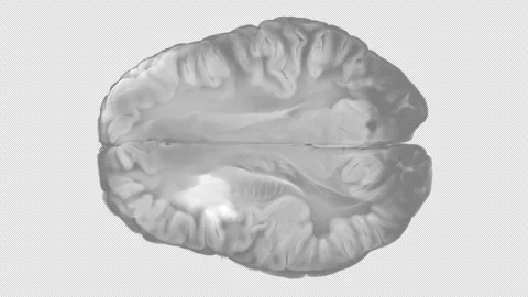 Detailed MRI Scan of Blood-Brain Barrier... | Stock Video | Pond5