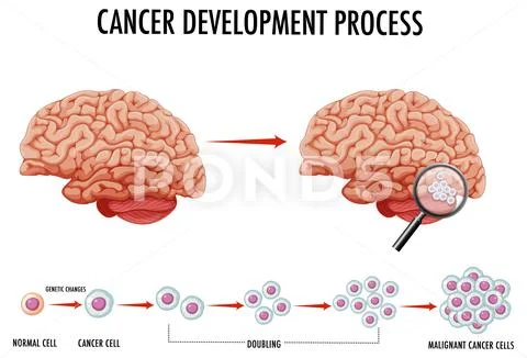 Diagram showing cancer in human brain ~ Clip Art #172574395