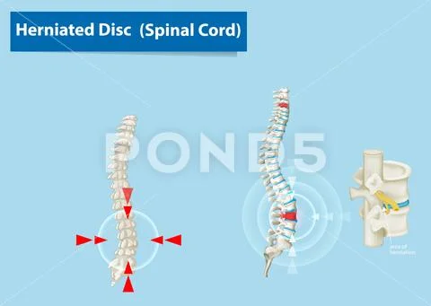 Diagram showing herniated disc in human: Royalty Free #119764642