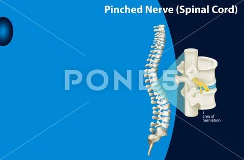 Diagram showing pinched nerve: Royalty Free #119764634
