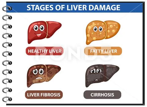 Diagram showing stages of liver damage: Graphic #171274849