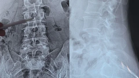 Digital radiography of a male lumbar spi... | Stock Video | Pond5