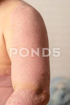 Diseases caused by abnormalities of the lymph. Psoriasis is a skin ...
