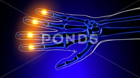 Distal interphalangeal joints pain Anatomy For Medical Concept 3D ...