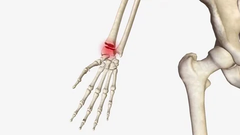 Distal radius fractures are the most com... | Stock Video | Pond5
