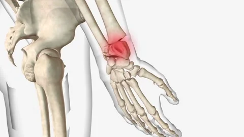Distal radius fractures are the most com... | Stock Video | Pond5