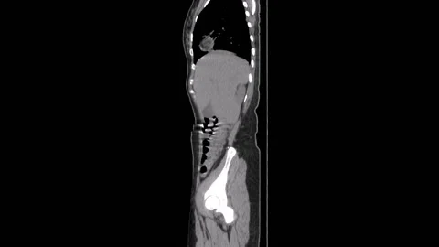 Distended stomach, CT scan | Stock Video | Pond5