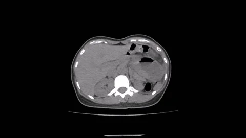 Distended stomach, CT scan | Stock Video | Pond5