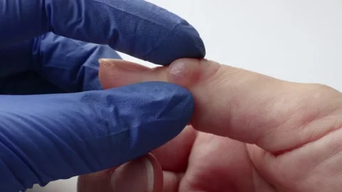 Doctor checkup a ganglion cyst on a fing... | Stock Video | Pond5