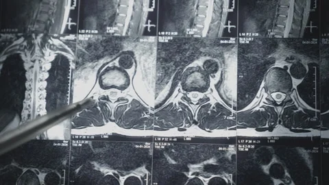 Doctor Examining Axial Spine MRI Scan, C... | Stock Video | Pond5