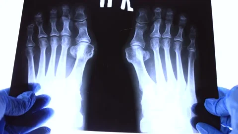 Doctor hands with x ray scan of feet and... | Stock Video | Pond5